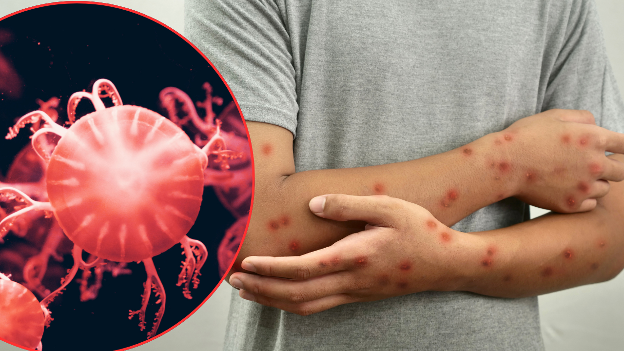 First Locally Acquired Clade 1 Mpox Case Detected California, Symptoms ...