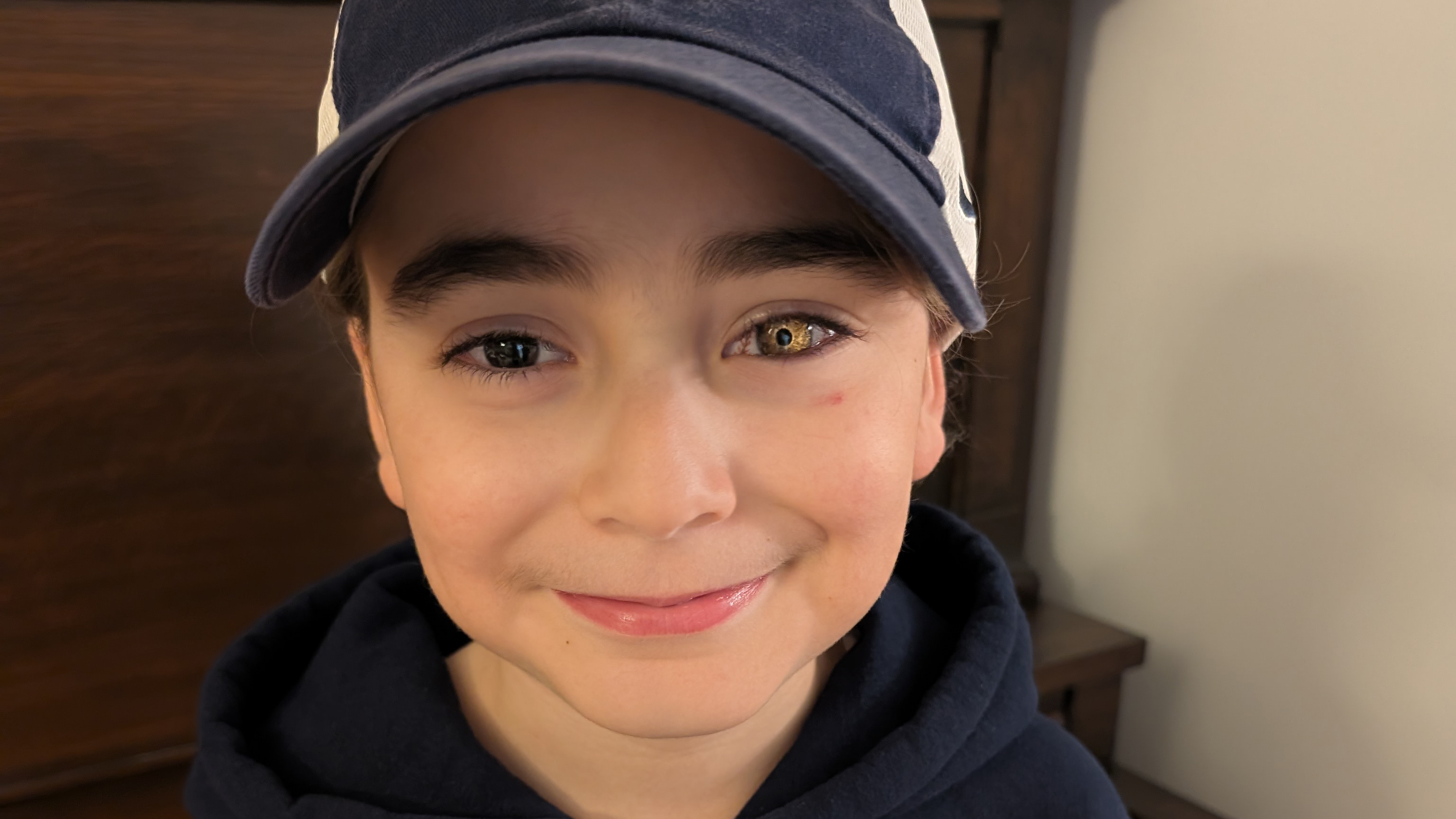 Eight-year-old shows his love for the Blue Jays with custom prosthetic eye
