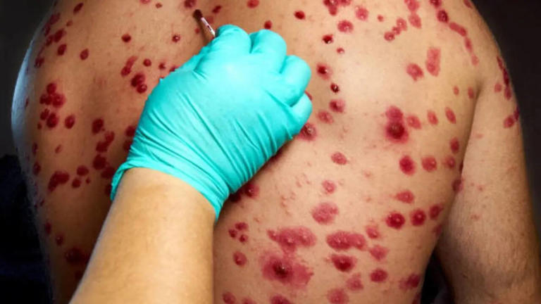 Chickenpox Cases Surge in Kerala's Kollam, District on Alert; How Fast ...