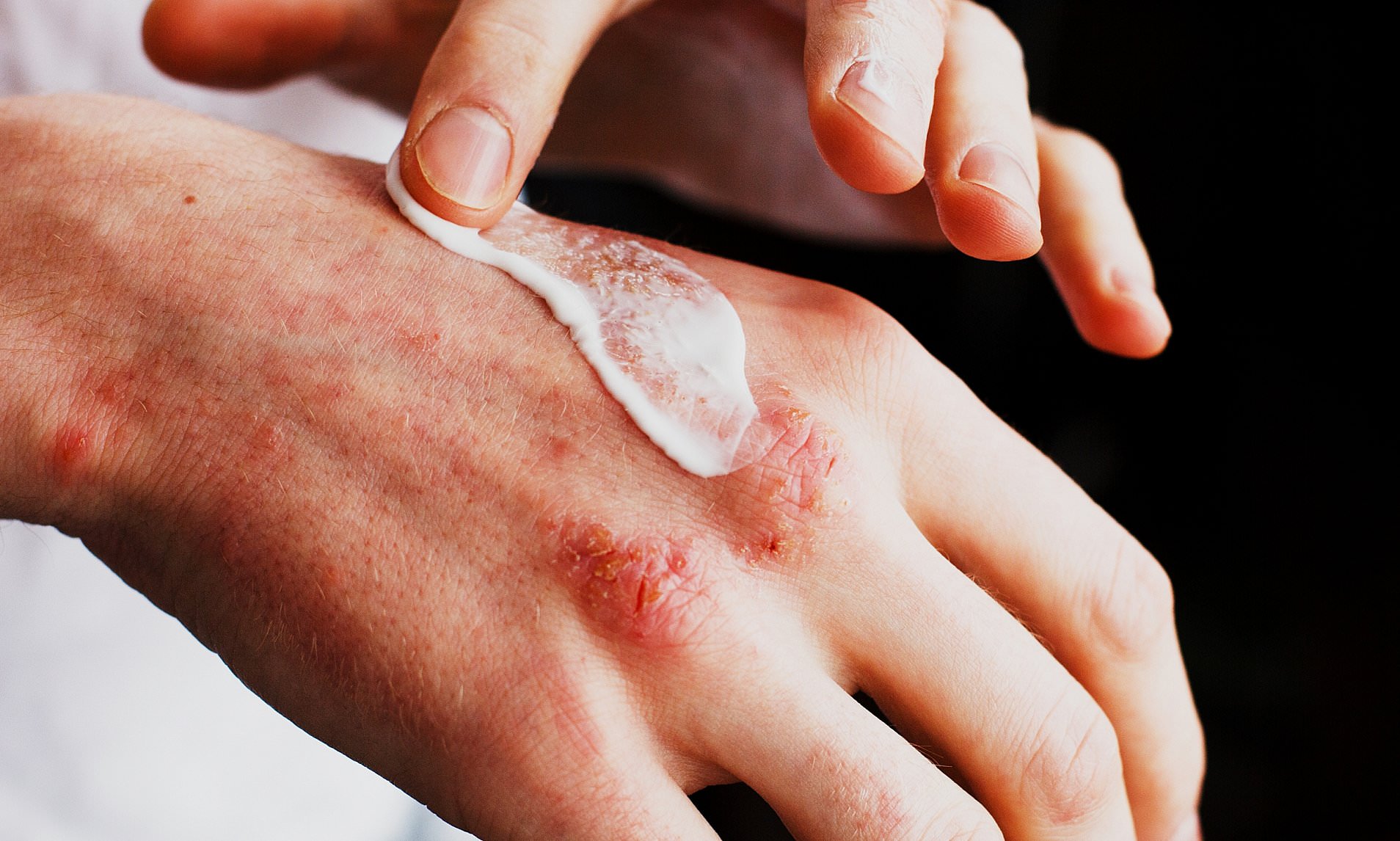 How to soothe dry, sore hands fast - skin specialists share the simple ...