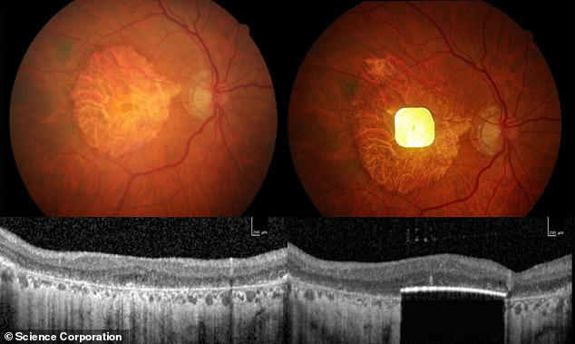The chip that could cure blindness: 'Pioneering' device restores vision ...