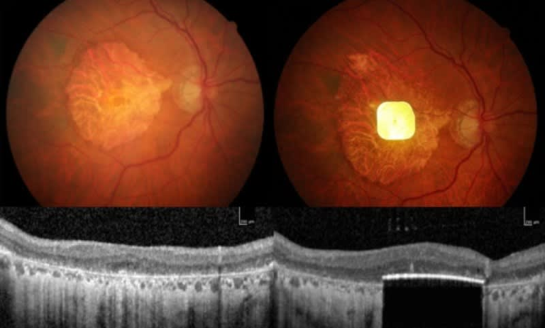 An Implant Offers New Hope for Incurable Eye Disease