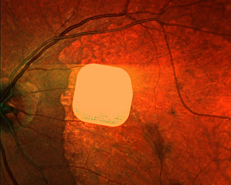 Electronic Implant Helps Blind Patients Read Again