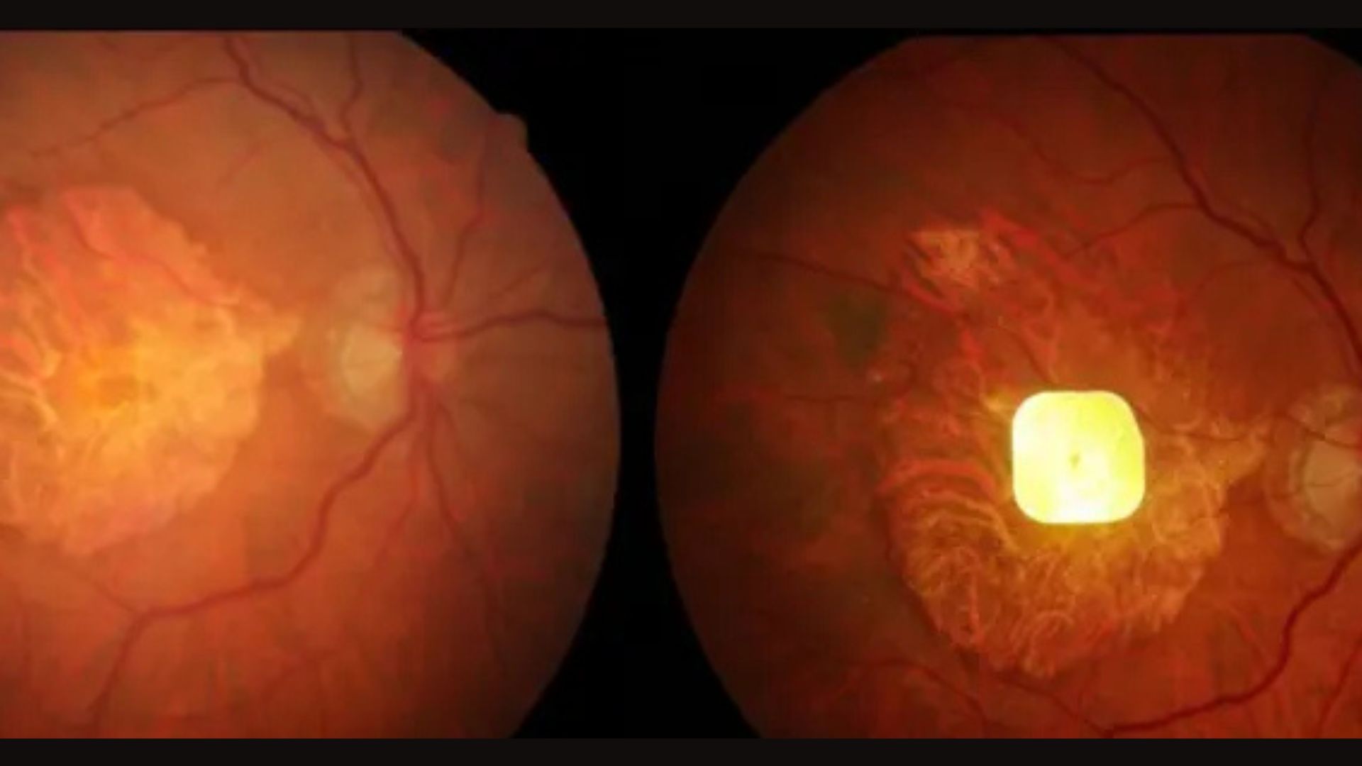 AI-powered eye implant helps blind patients read again after years ...