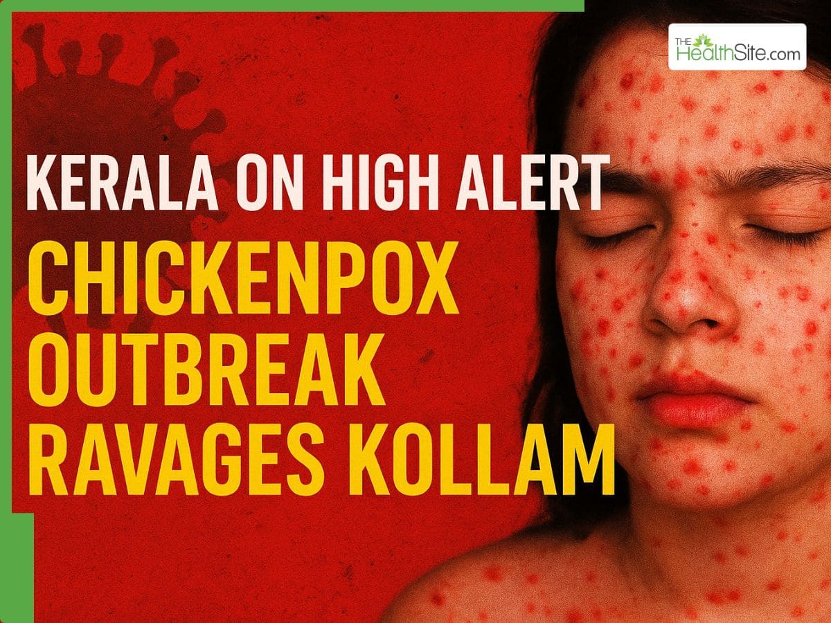 Kerala On High Alert: Chickenpox Outbreak Ravages Kollam, Expert Urge ...