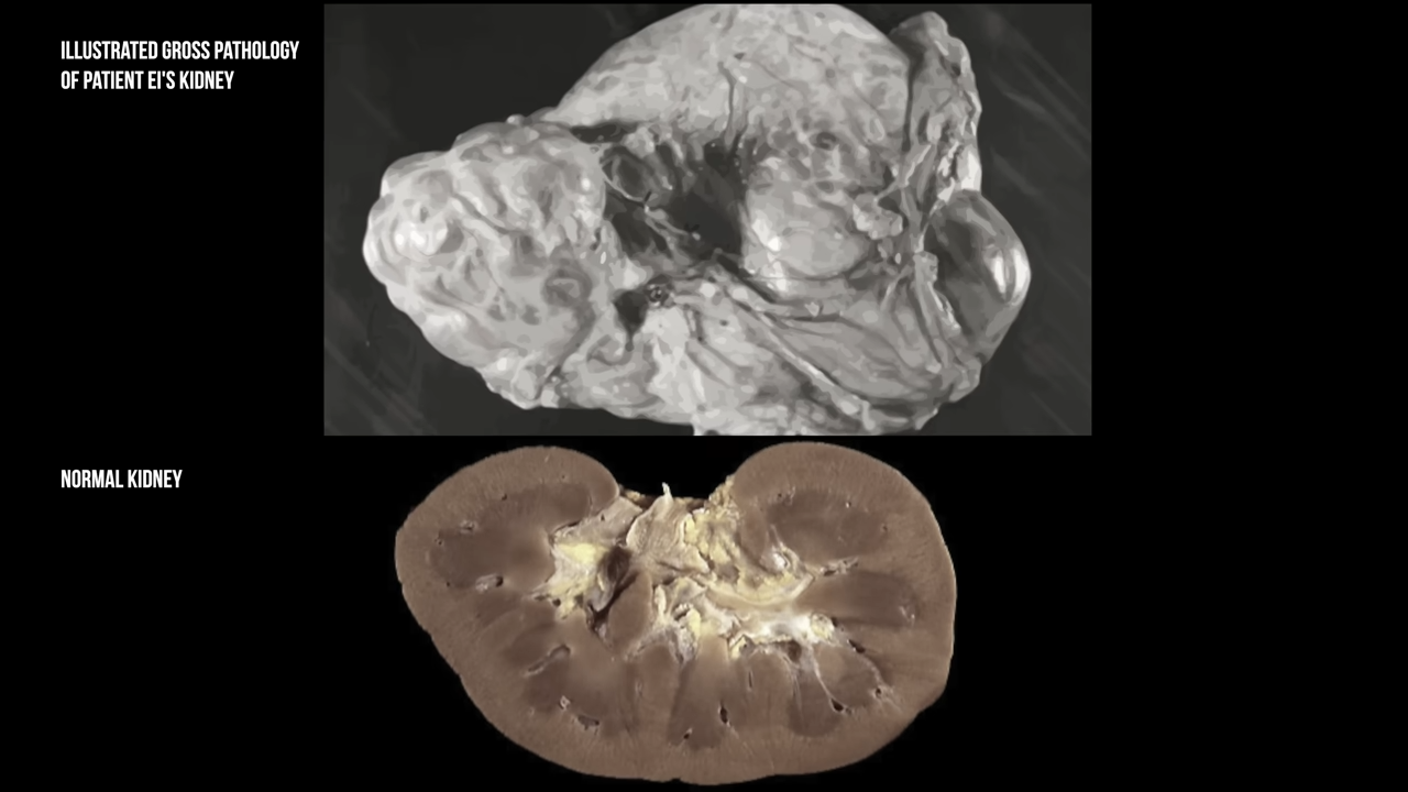 What vitamin D overdose does to your kidneys