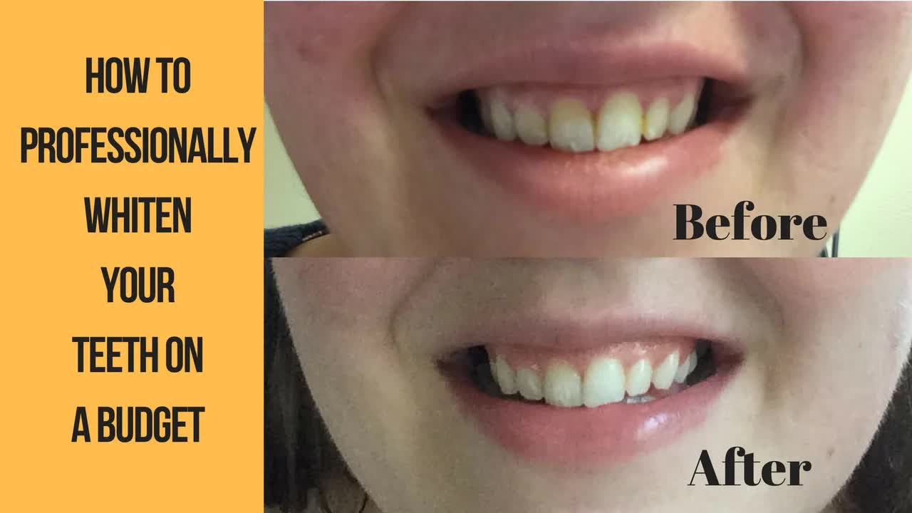 How to whiten your teeth on a budget feat. Smile Brilliant!