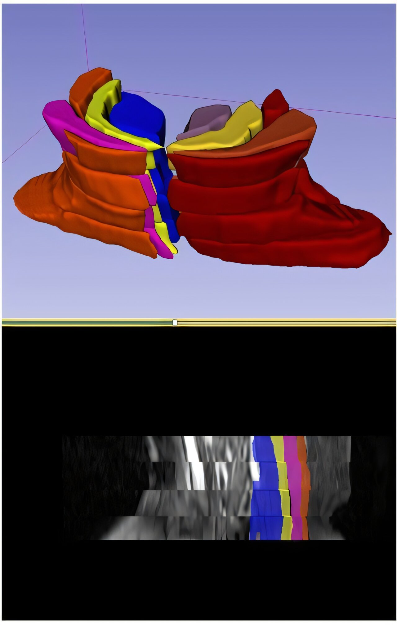 MRI-based evaluation system accurately quantifies paraspinal muscle ...