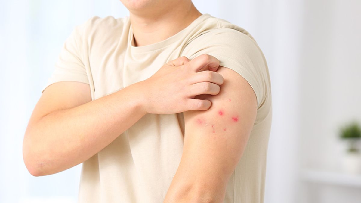 México confirma primer caso de viruela símica en paciente alemán