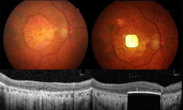 New eye implants combined with augmented-reality glasses help blind ...