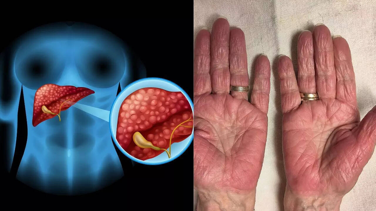 Liver damage warning signs visible on your hands; here’s what you need ...