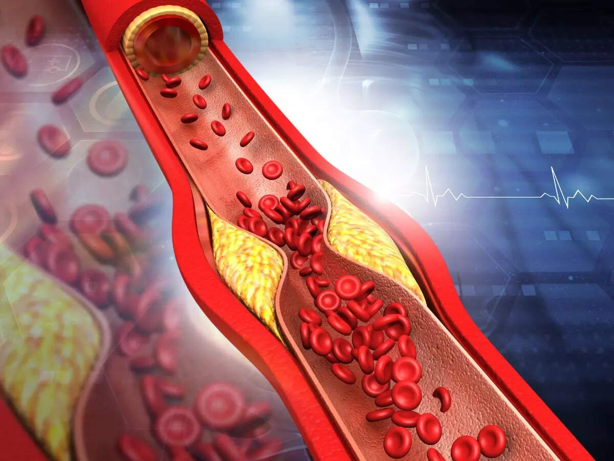 Heart health: 5 major causes of coronary disease and artery blockage