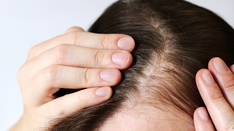 Balding (hair loss) is inherited from father's or mother's side? This ...