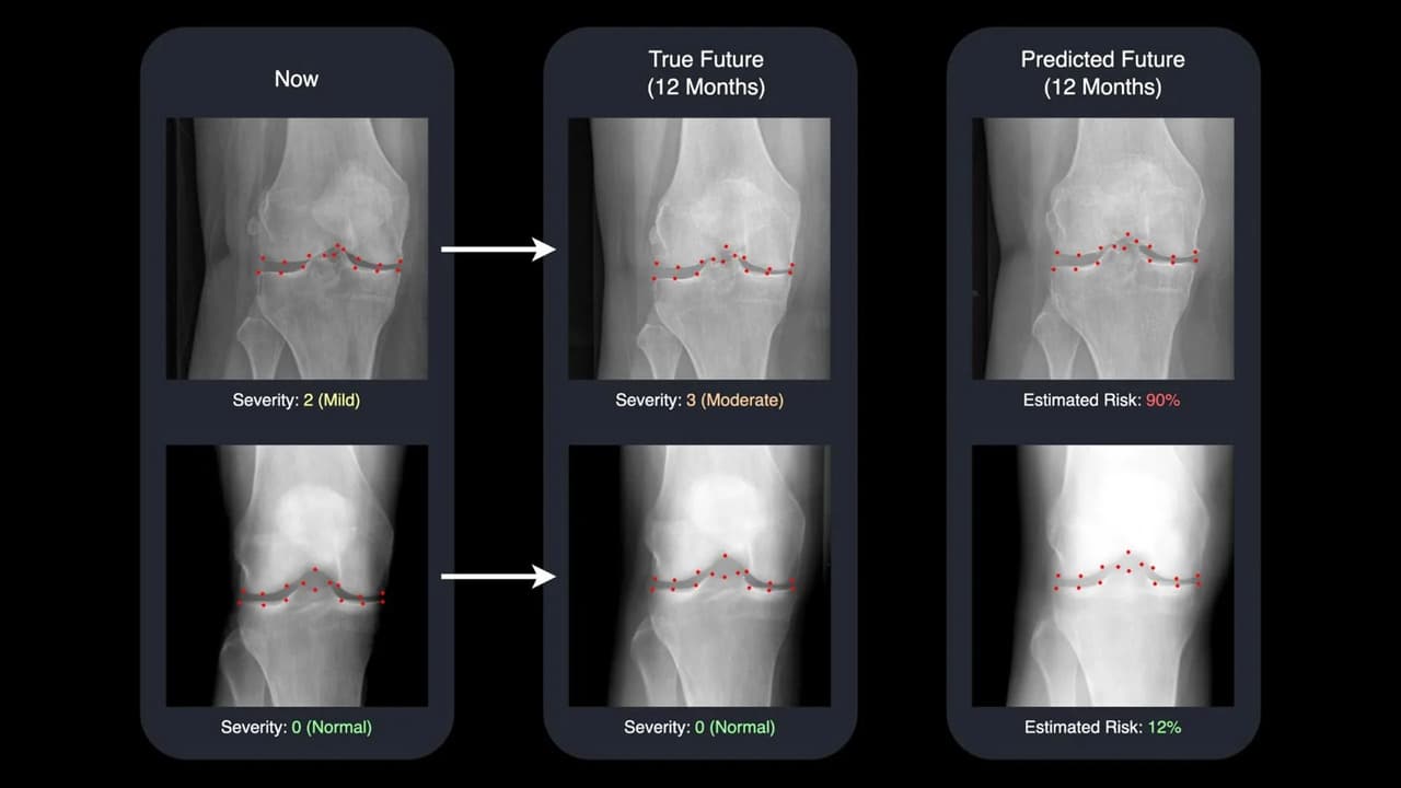 AI Predicts Future Knee X-Rays to Transform Arthritis Treatment