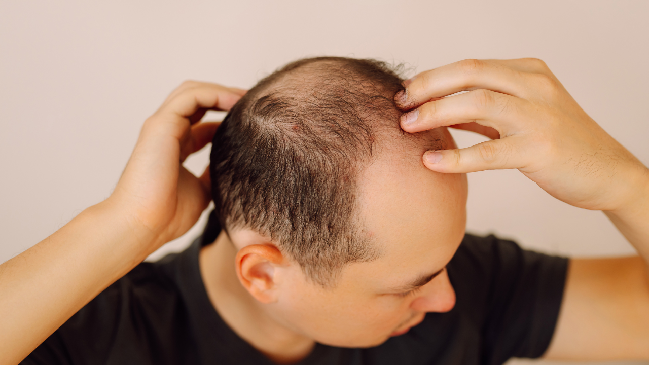 Balding (hair loss) is inherited from father's or mother's side? This ...