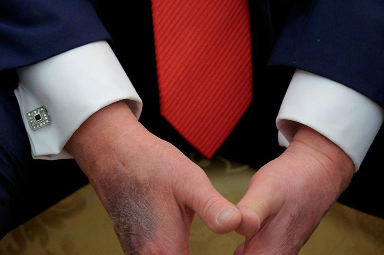 Everything we know about Trump's bruise, swollen ankles and more ahead ...