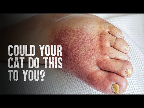 How to Handle Cat Scratch Fever Safely
