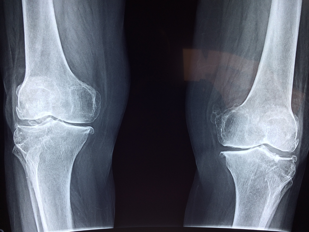 Want stronger bones? This fruit packs more Calcium than any other, says ...