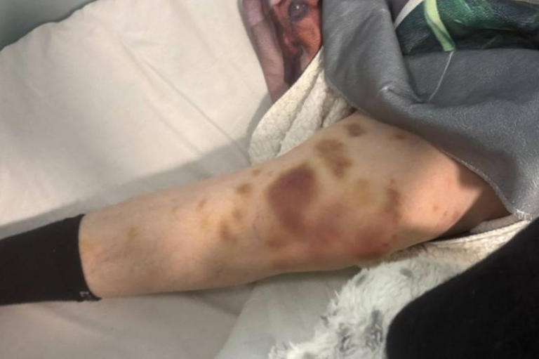 'We showed them mum's bruises, but were told to put a helmet on her head'