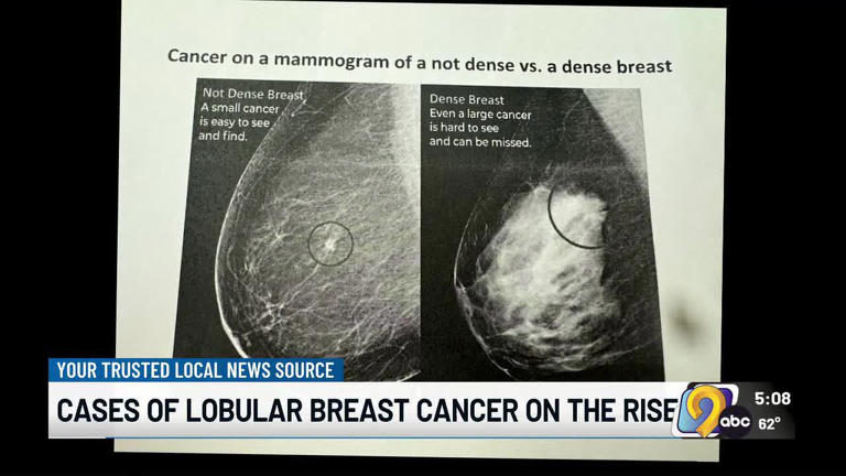 Iowa doctor says a lesser-known type of breast cancer is on the rise