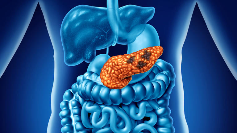The Pathway Causing Pancreatic Cancer Spread Was Identified, Here's ...