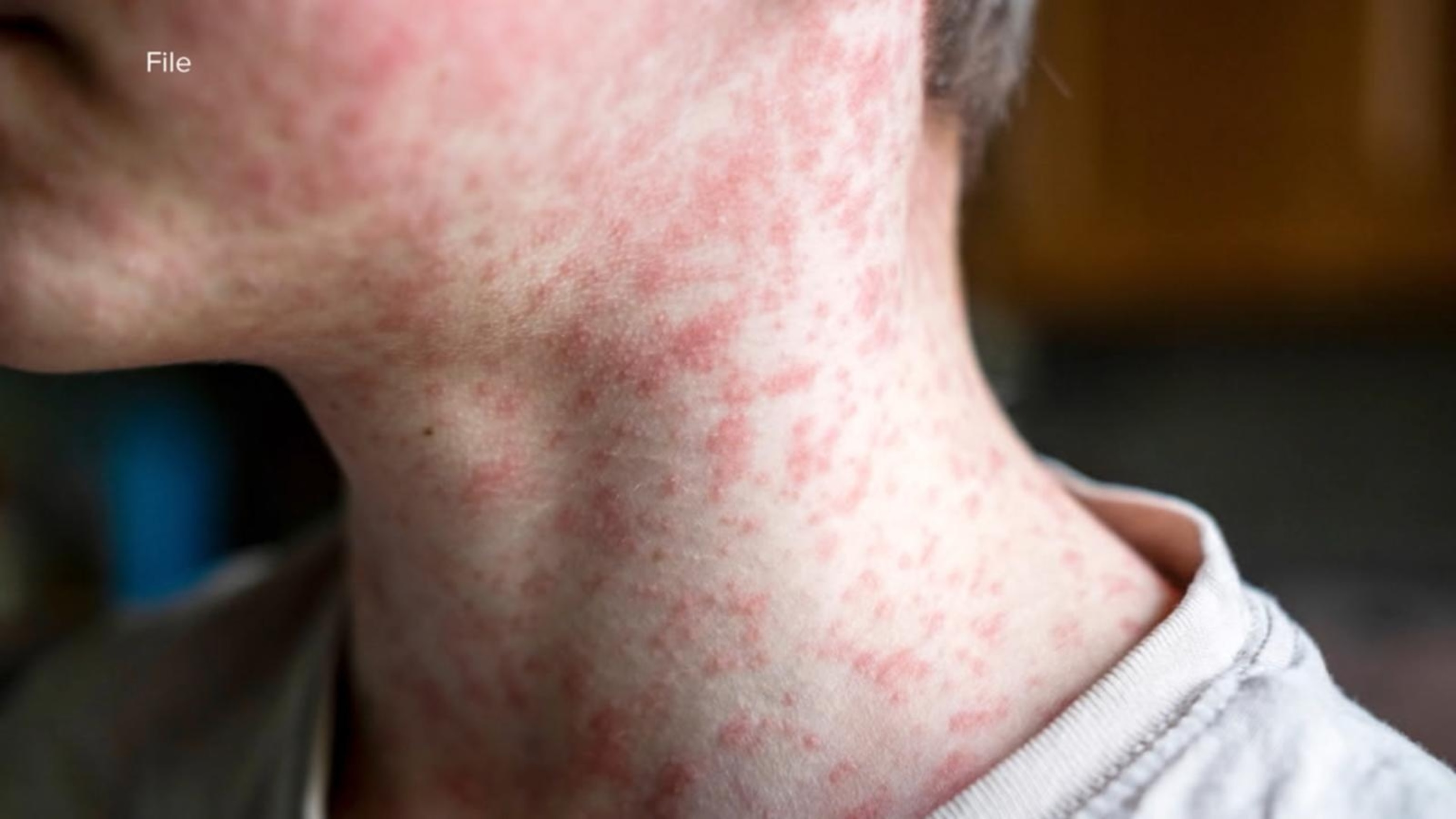 Quarantine recommend for unvaccinated students after measles exposure