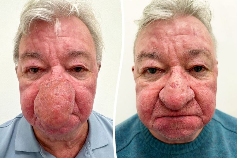 Grandad, 68, 'unable to kiss wife for years' after 'worst case' of nose ...