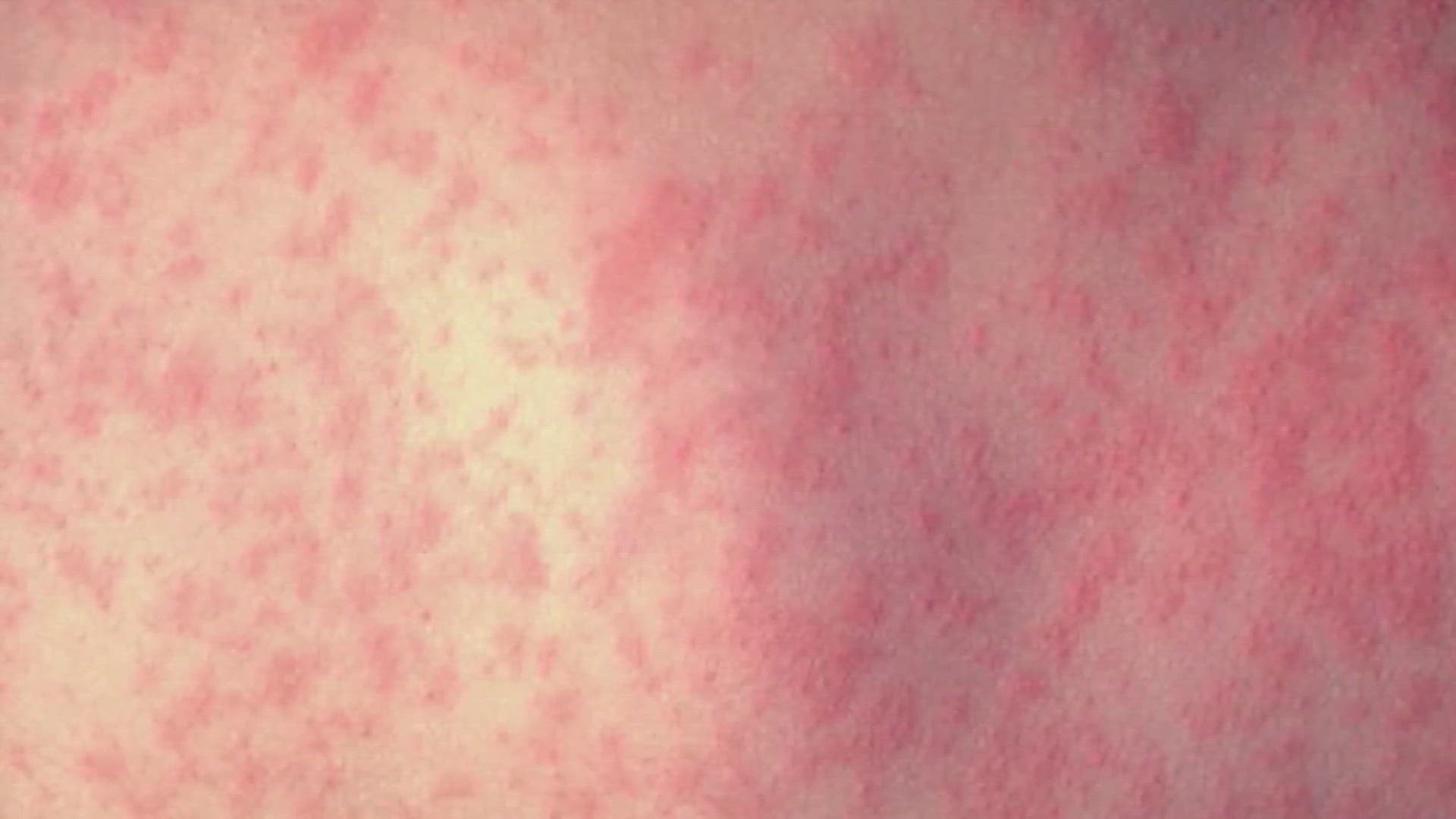 153 unvaccinated children in quarantine after measles exposure