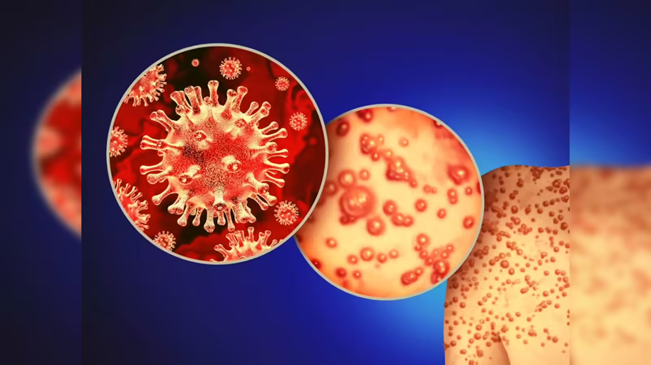 Maharashtra reports first case of monkeypox; infected person arrived ...