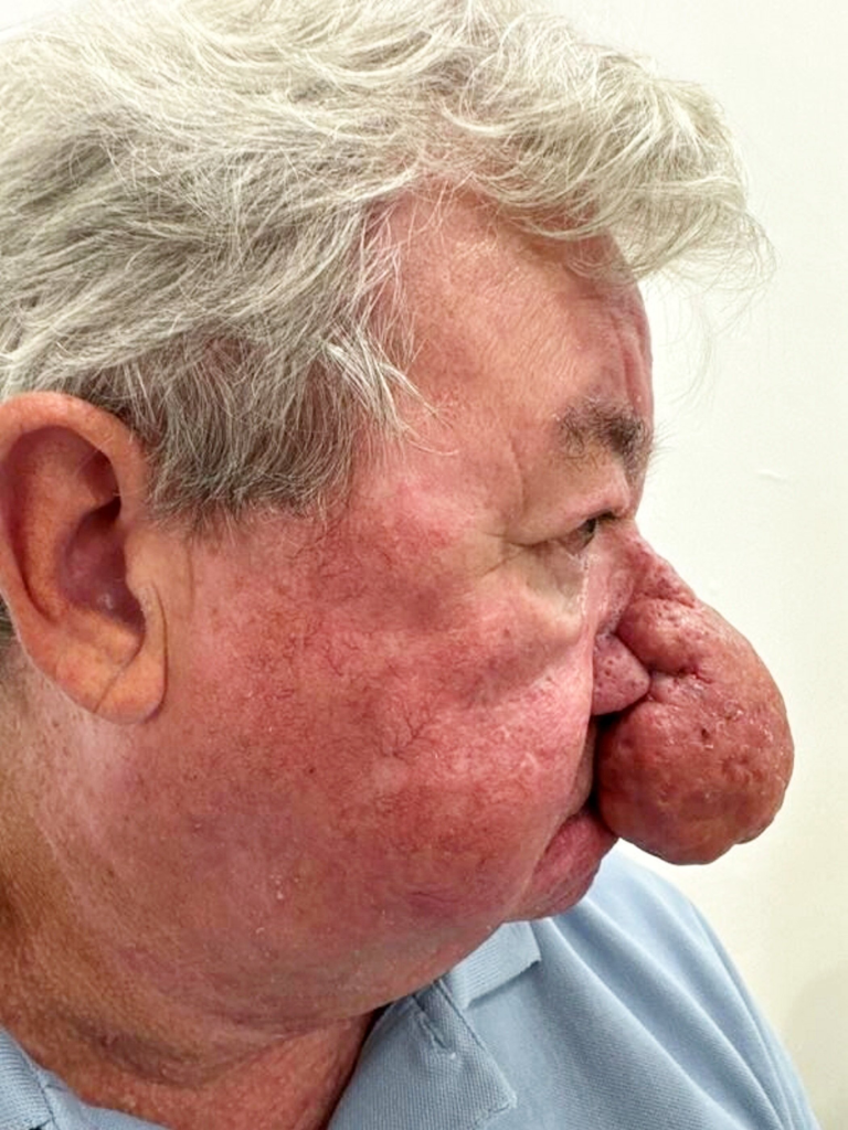 Man undergoes life-changing surgery for massive nose growth