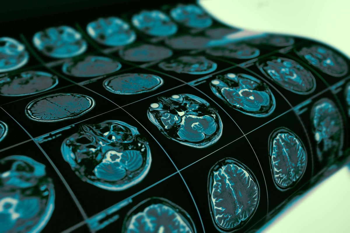 Brain cancer patients left ‘devastated’ as new drug is rejected for NHS use