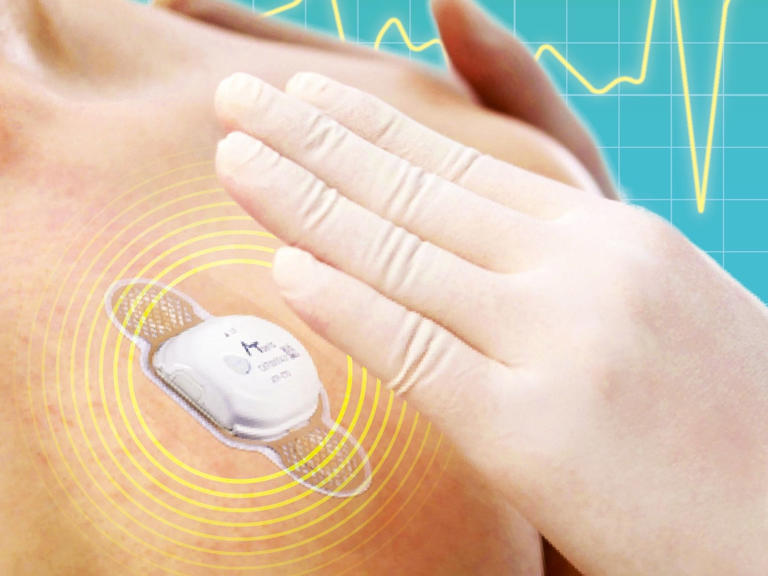 500 Won Coin Sized Ecg Patch Detects Hidden Arrhythmia