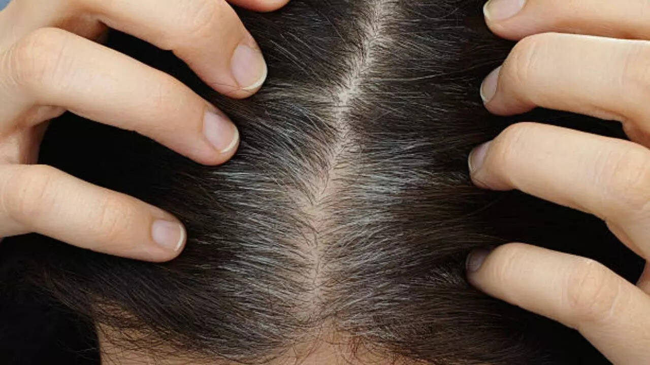 Grey hair in your 20s? 5 key nutrients that slow premature greying
