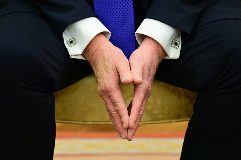 Donald Trump health in crisis as he uses makeup to hide recurring bruise