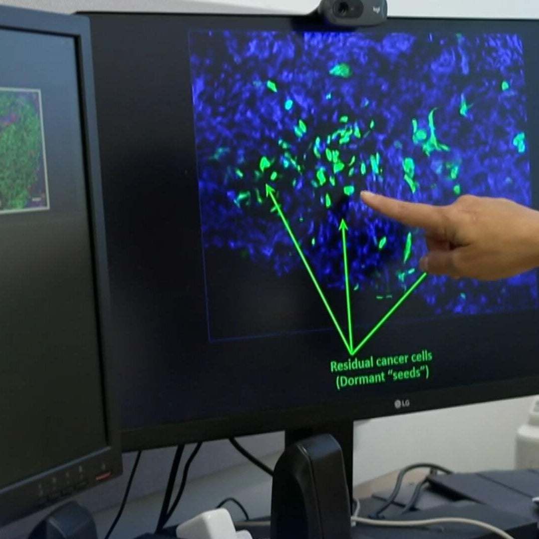 Researchers seek to halt breast cancer recurrence by targeting "sleeper ...