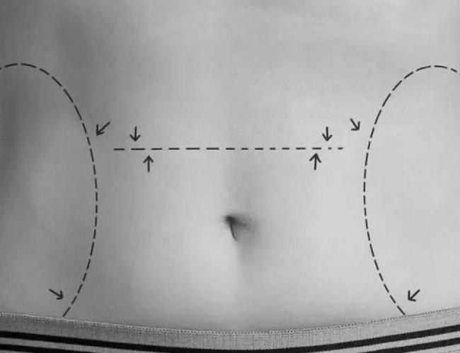 How your belly button can determine the success of your tummy tuck