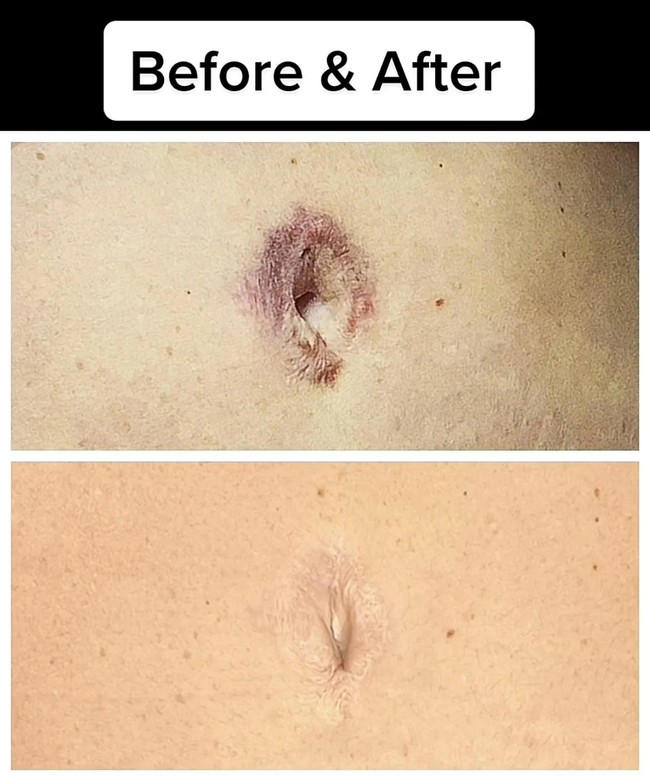 How your belly button can determine the success of your tummy tuck