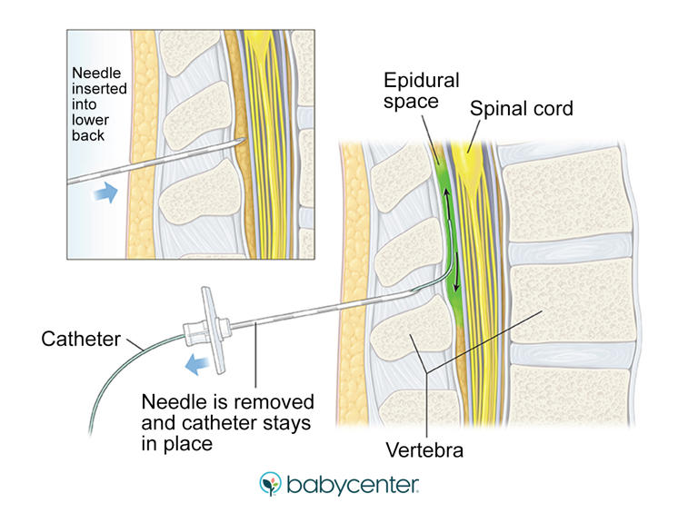 How epidurals work – and why they're the most common labor pain relief