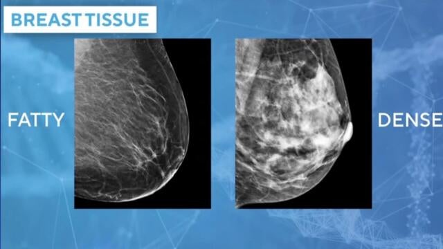 Doctors using AI mammogram readings to predict breast cancer risk