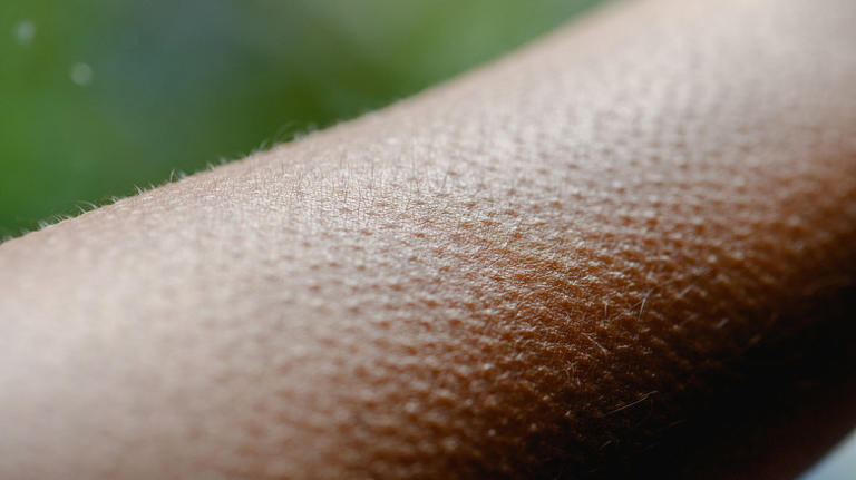 The 'Useless' Body Part That Explains Why Humans Get Goosebumps