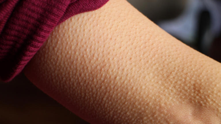 The 'Useless' Body Part That Explains Why Humans Get Goosebumps