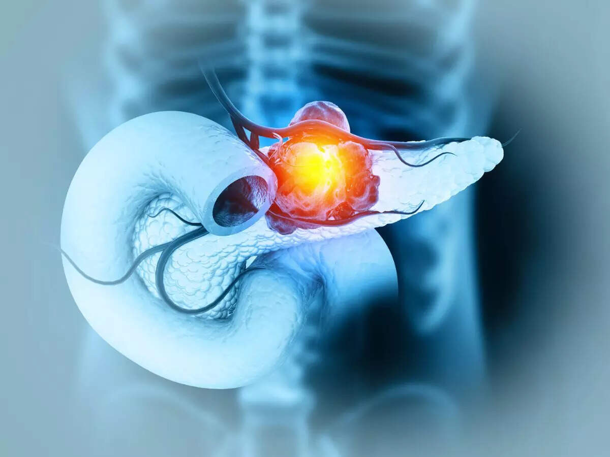 9 early signs of pancreatic cancer you should know