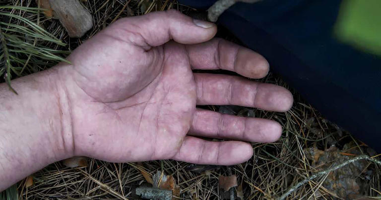 10-year-old girl badly injured after dart bomb explosion in Manila