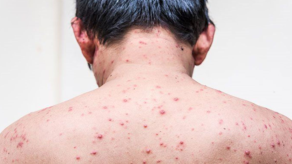 Chickenpox Recovery: What To Expect During Each Stage