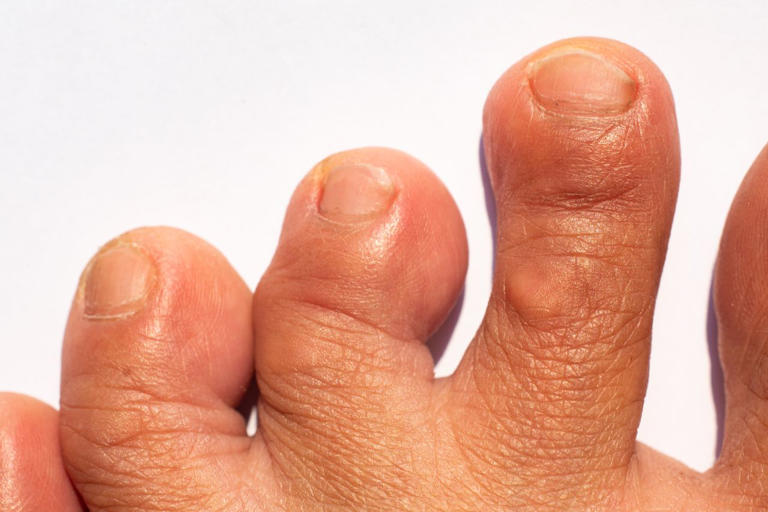 How Does Psoriatic Arthritis Affect Your Feet?