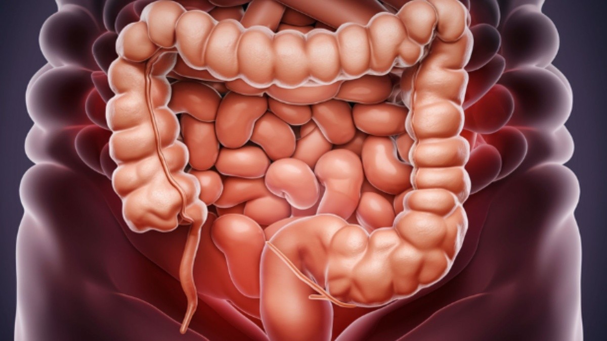 Cáncer de colon: nueve señales que no debes ignorar antes de que avance ...