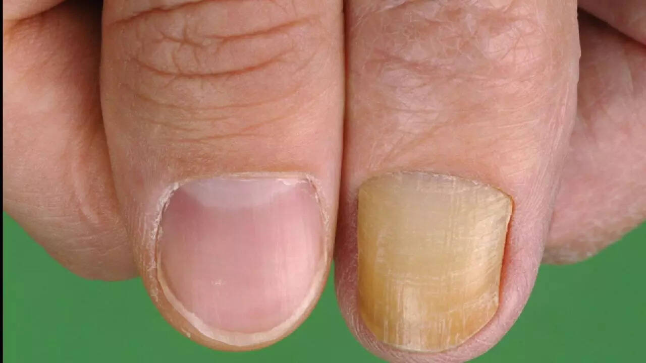 Why people with diabetes should never ignore yellow nails: The role of ...