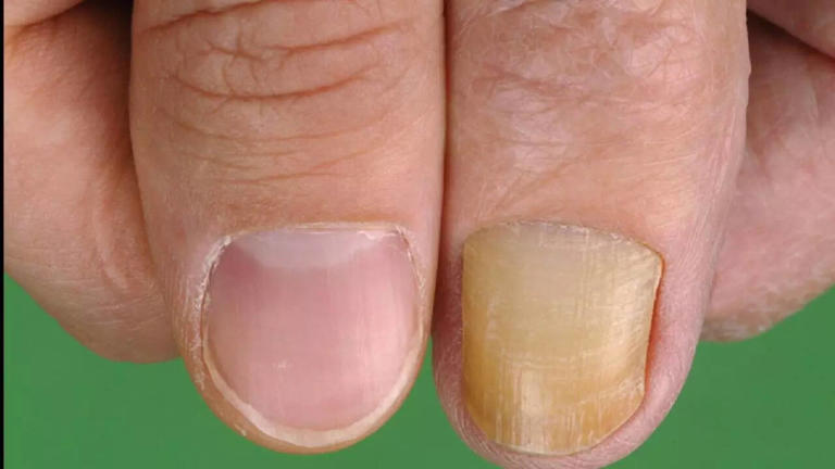 Why people with diabetes should never ignore yellow nails: The role of ...