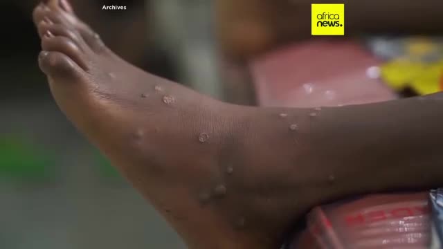 WHO reports rapid spread of Mpox with 17 deaths in Africa over recent weeks