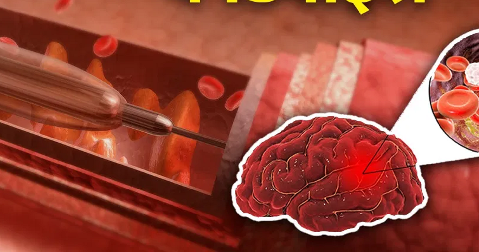 Breakthrough by Indian Scientists: New Device to Remove Brain Clots ...
